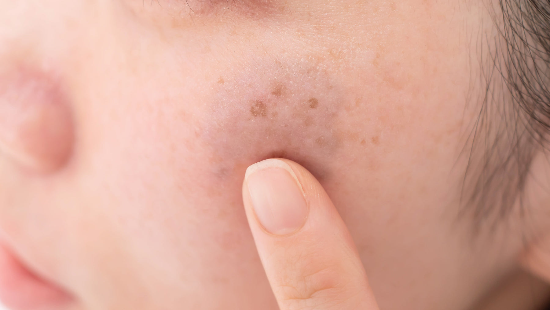 Pigmentation spots – Nadine Salembier